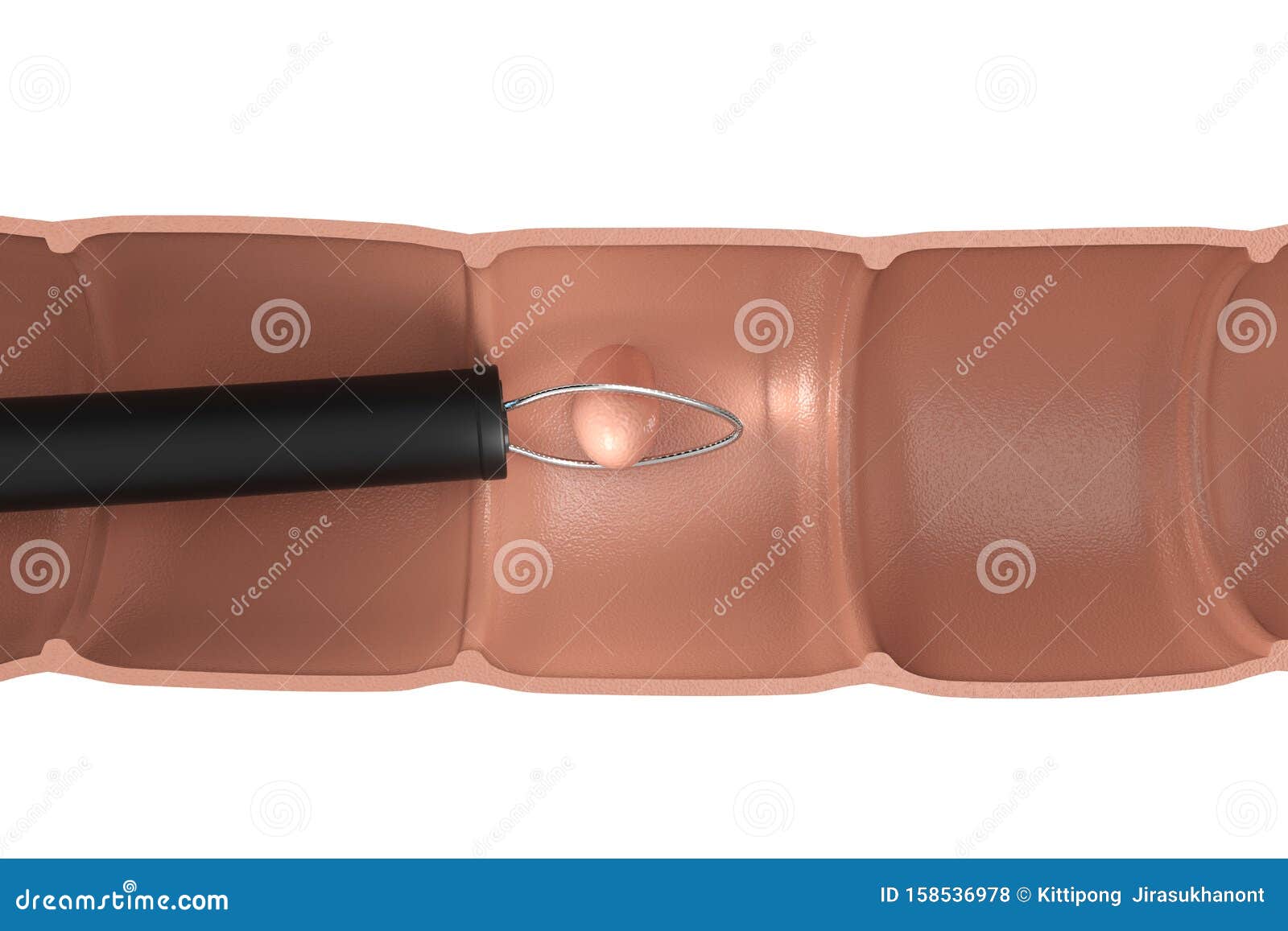 Endoscope Remove Colonic Polyp Stock Illustration - Illustration of ...