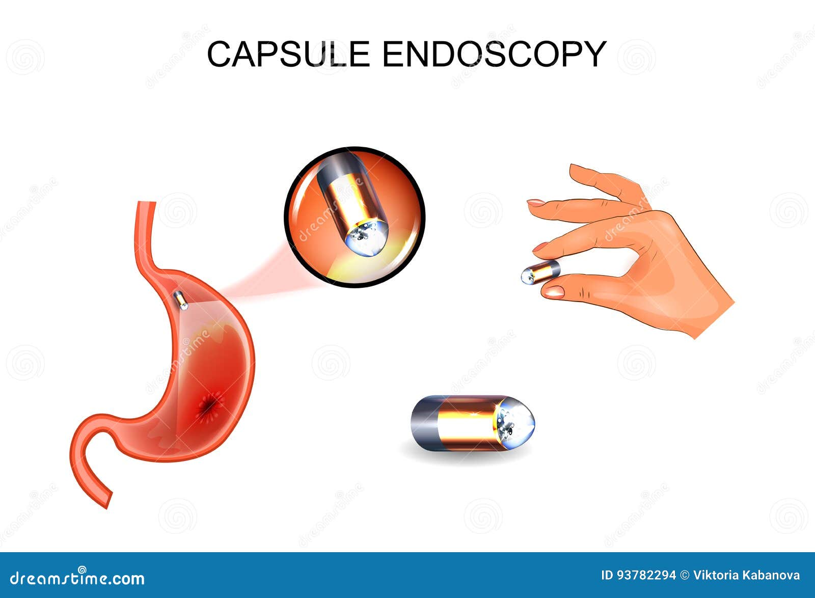 Endoscopia De La Cápsula EGD, Gastroenterología Ilustración del Vector ...