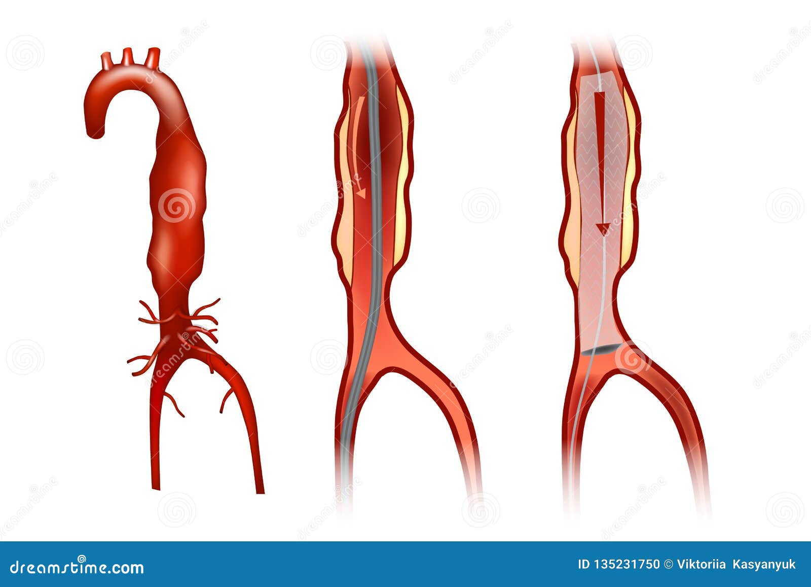 Endovascular Aneurysm Repair Stock Vector - Illustration of internal ...