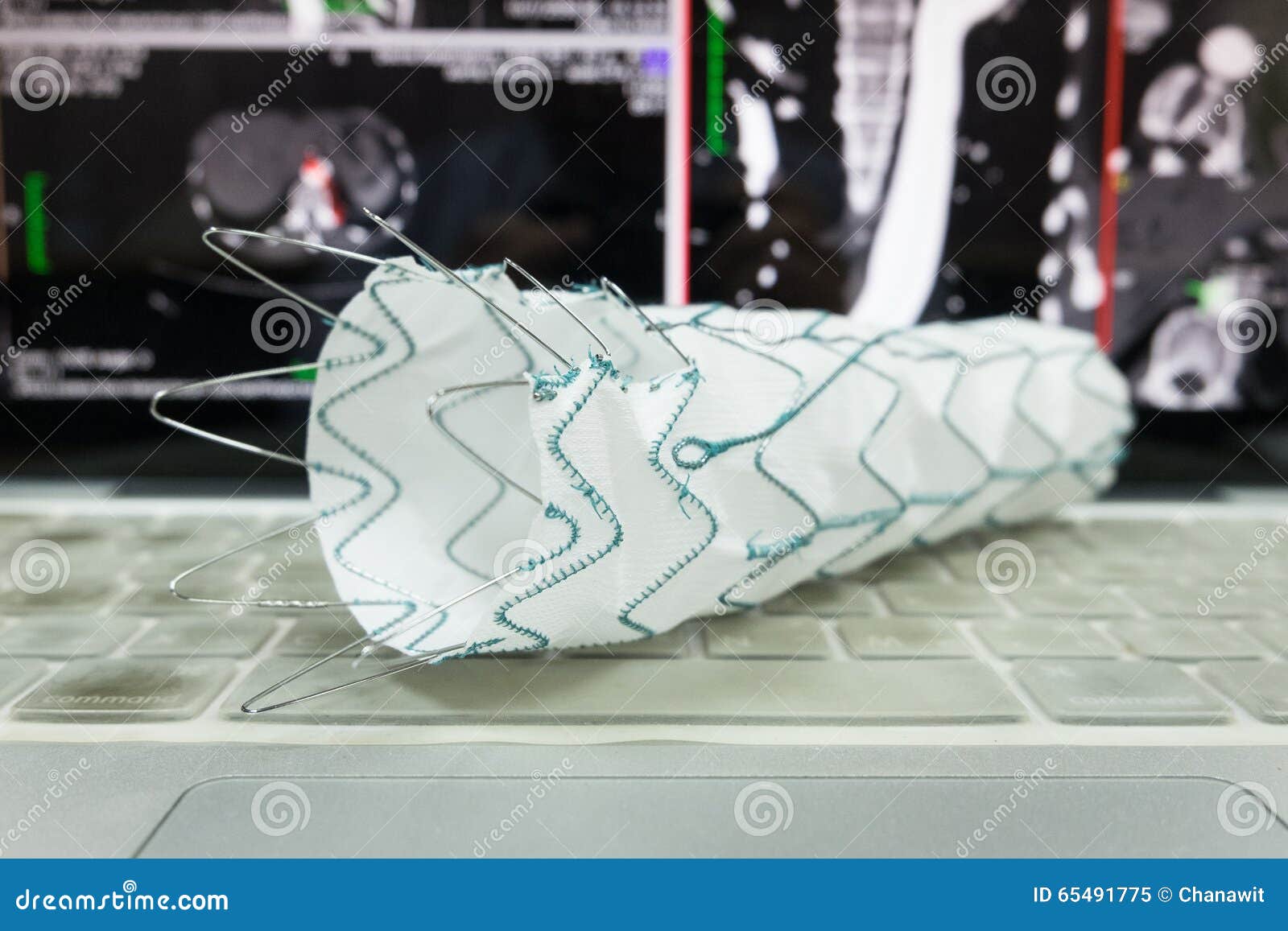 Endovascular stent graft stock image. Image of artery - 65491775