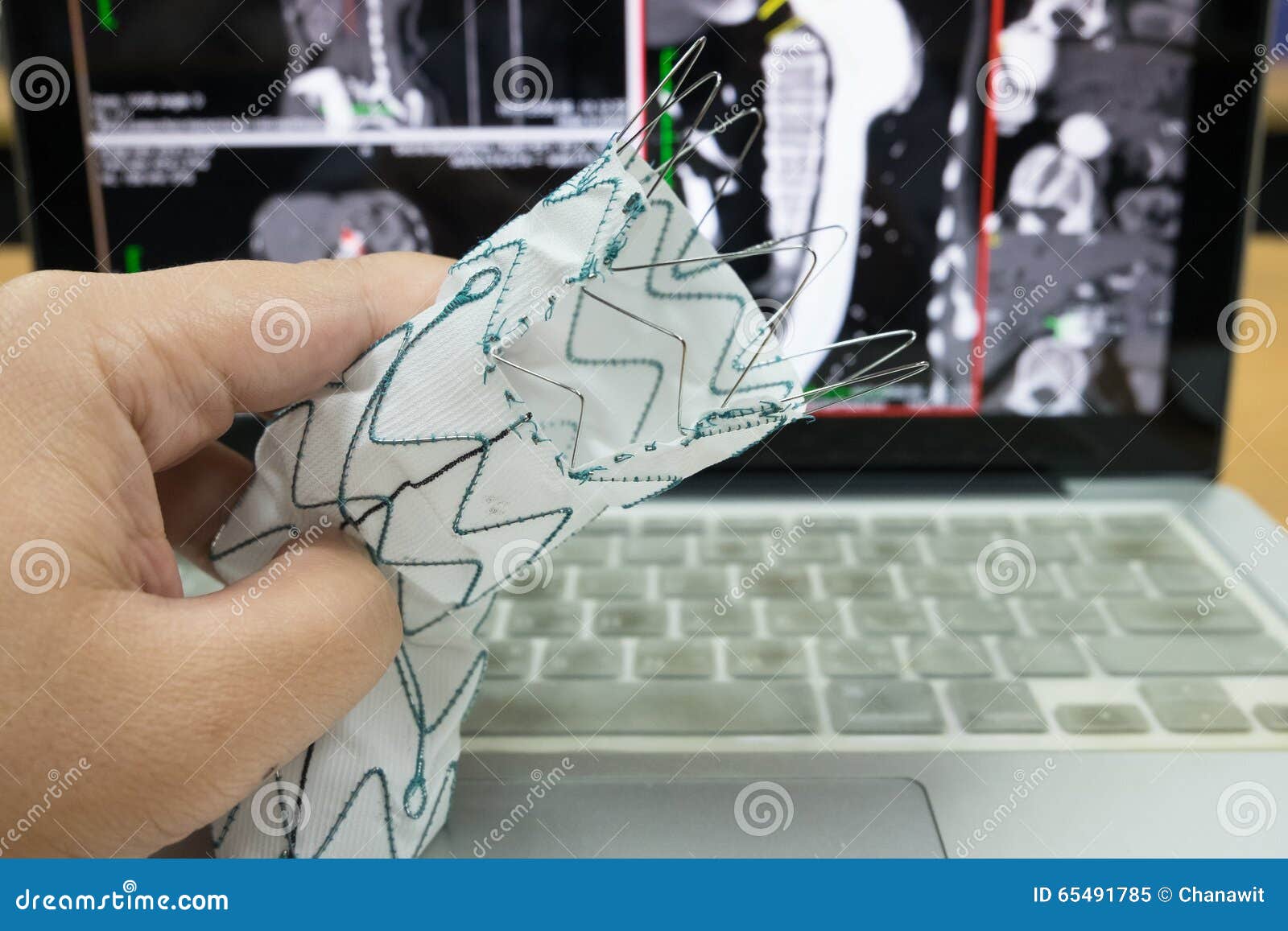 Endovascular stent graft stock image. Image of mesh, repair - 65491785