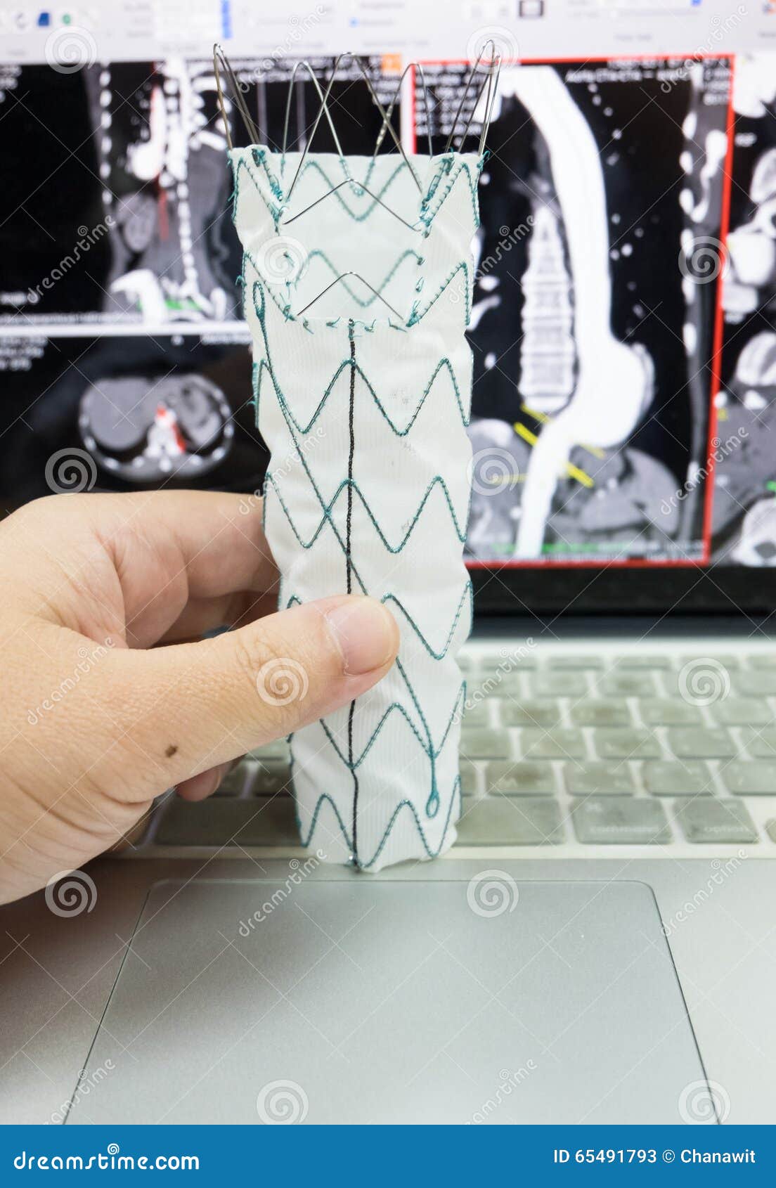 Endovascular stent graft stock image. Image of aneurysm - 65491793