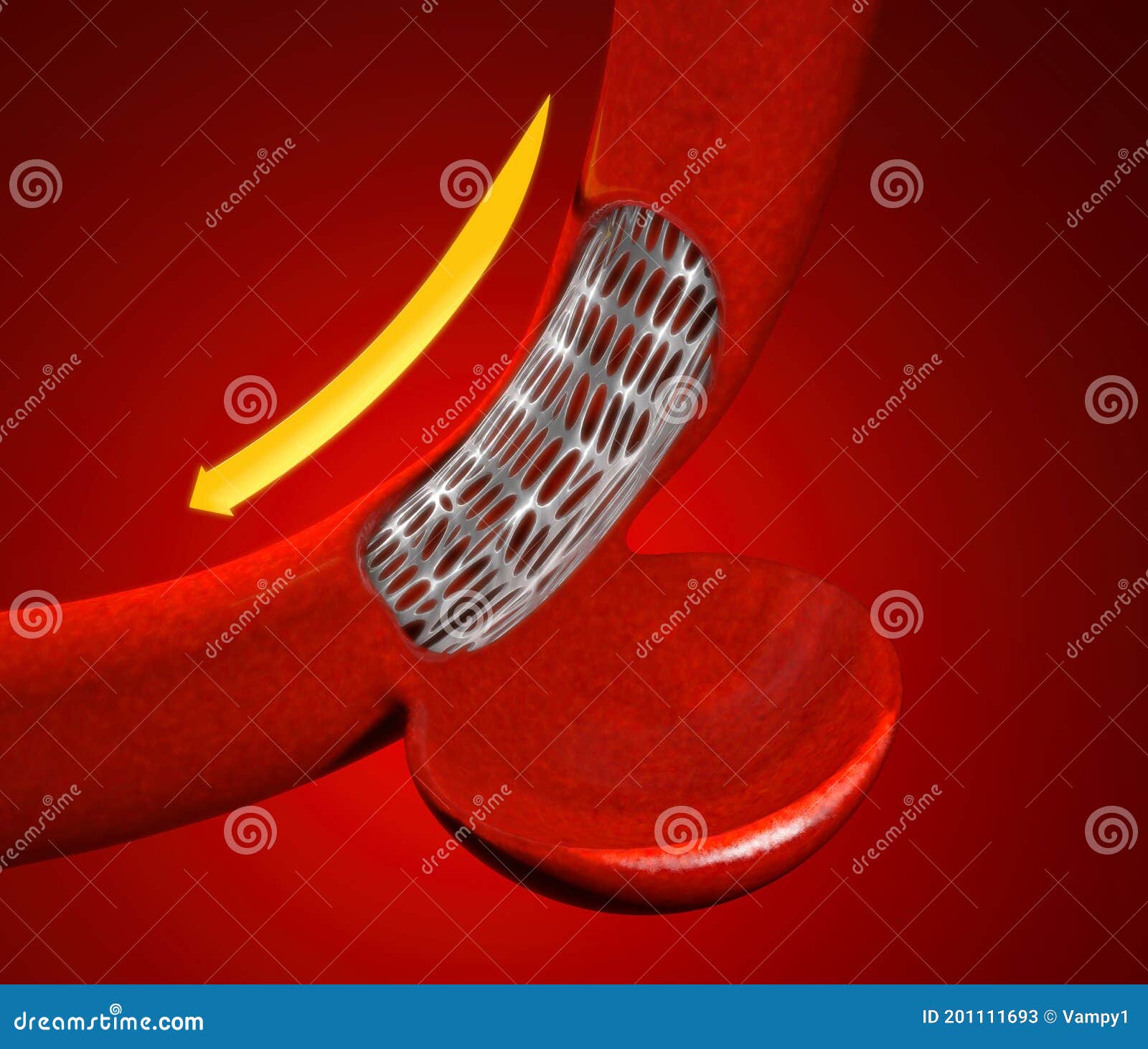 Endovascular Treatment of Intracranial Aneurysms. Brain Stock ... Endovascular Treatment of Intracranial Aneurysms. Brain Stock ...