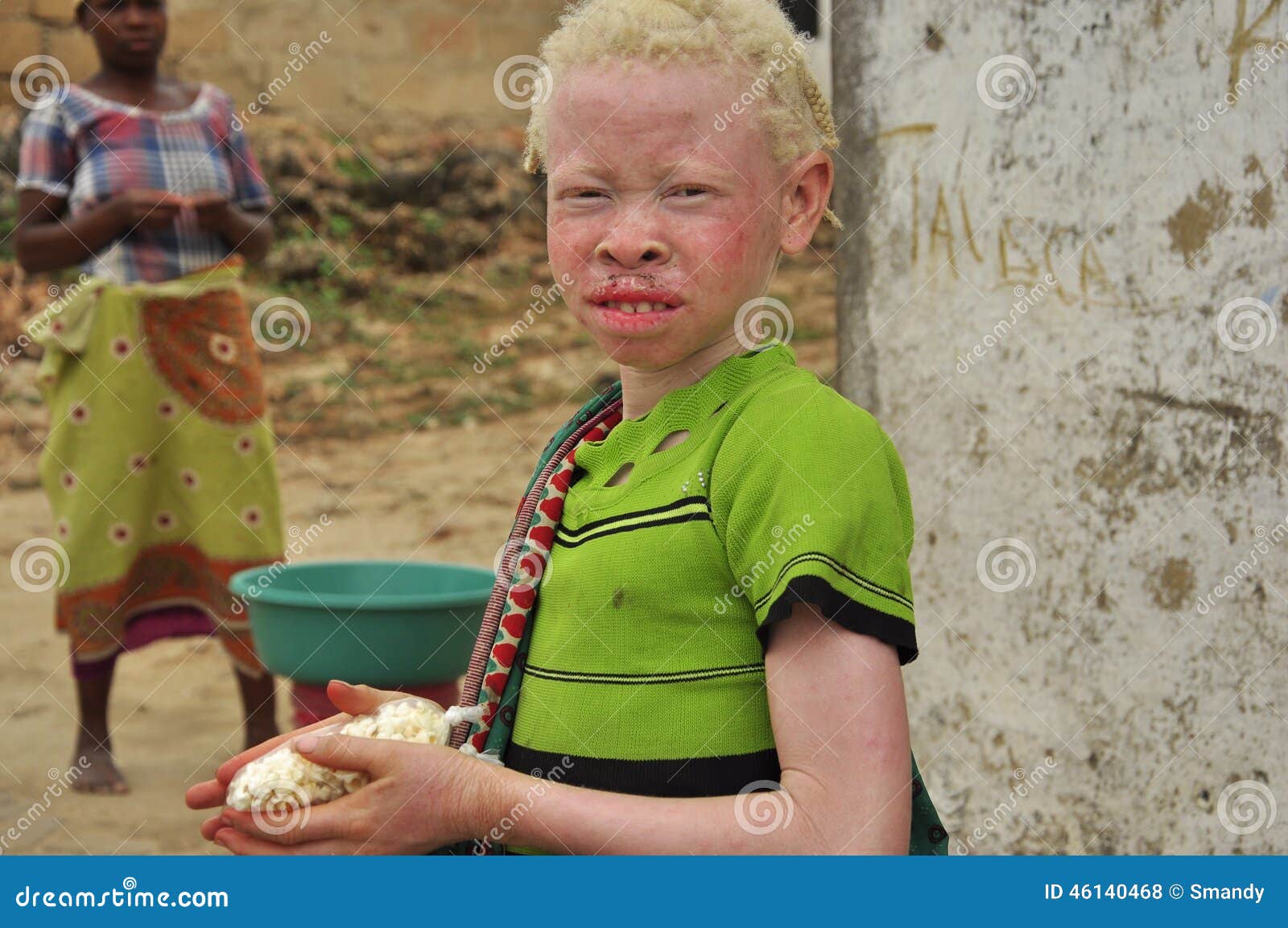 Enfant Albinos De L'Afrique Photo stock éditorial - Image du détruit ...
