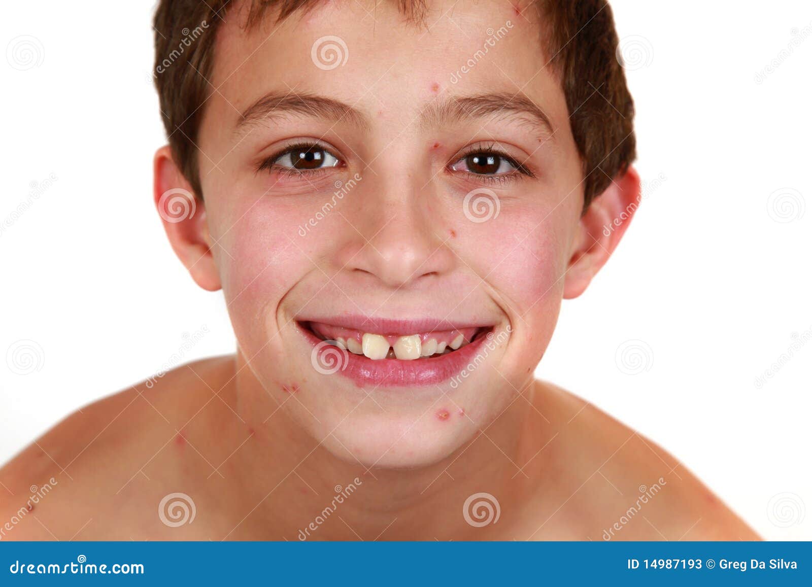 Enfant avec la varicelle image stock. Image du enfance - 14987193