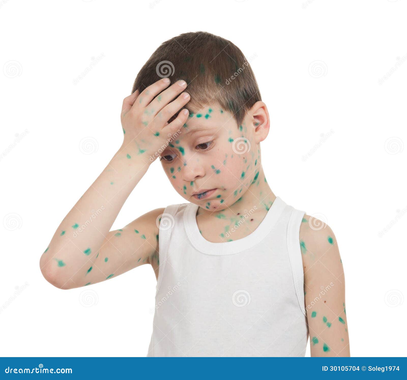 Enfant malade. varicelle photo stock. Image du disease - 30105704