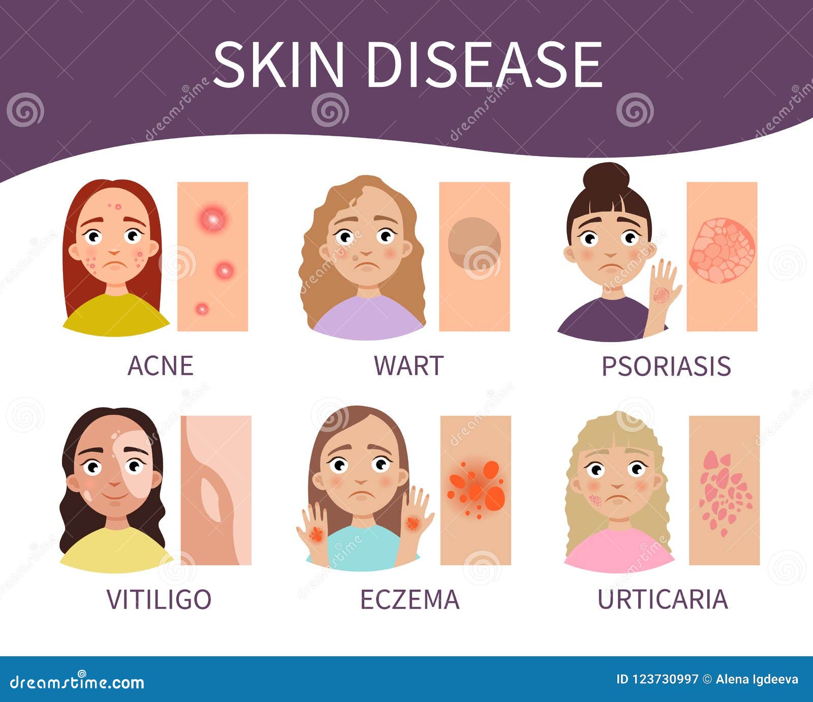 Enfermedad de la piel ilustración del vector. Ilustración de espinilla ...