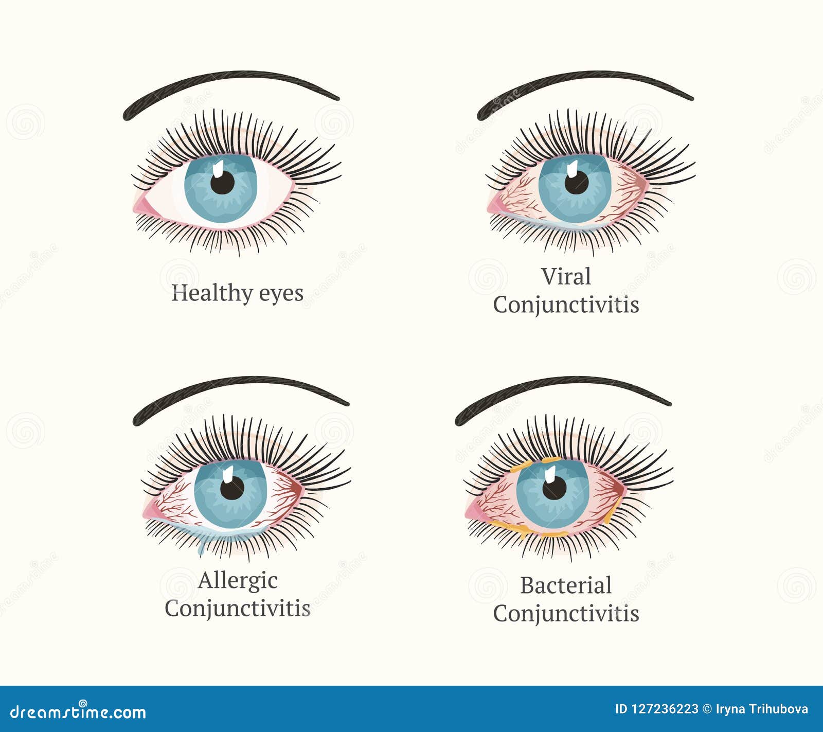 Enfermedad Ocular Ejemplo De La Salud De La Oftalmología Ilustración