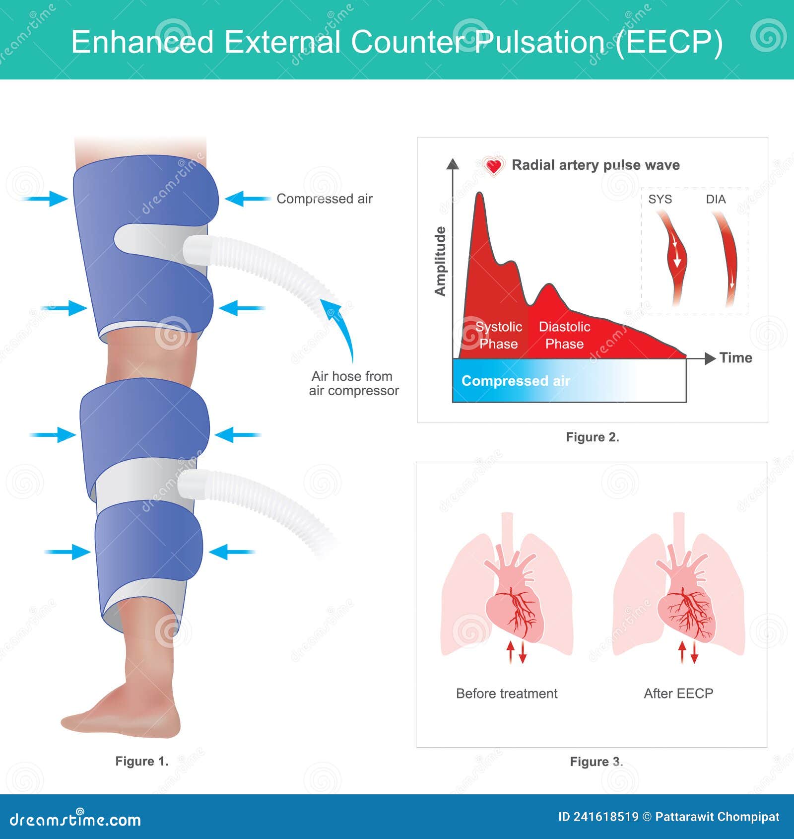 Enhanced External Counter Pulsation. Illustration. Stock Vector ...
