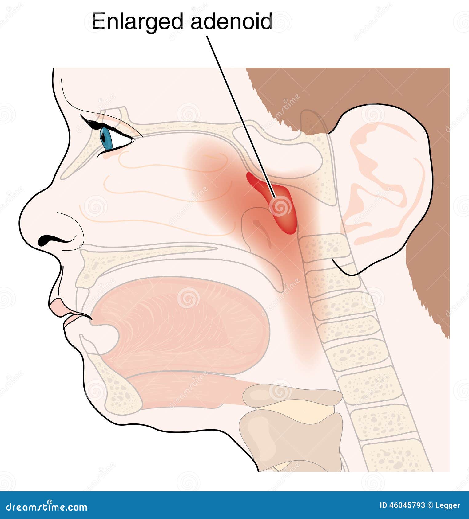 Enlarged adenoid glands stock vector. Illustration of cross - 46045793 Enlarged adenoid glands stock vector. Illustration of cross - 46045793