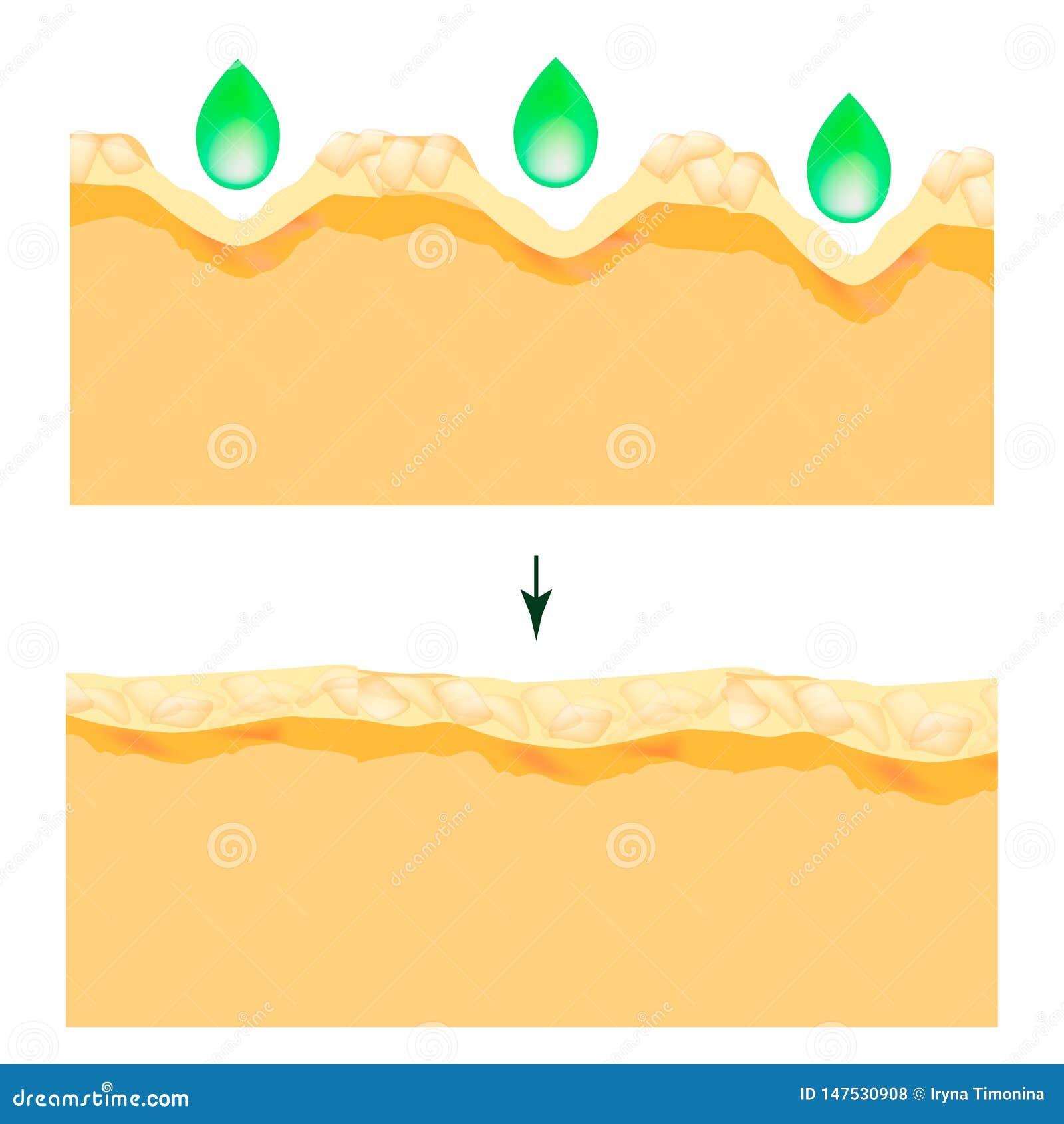 Enlarged Pores. the Structure of the Skin. Wrinkles, Acne Scar ... Enlarged Pores. the Structure of the Skin. Wrinkles, Acne Scar ...