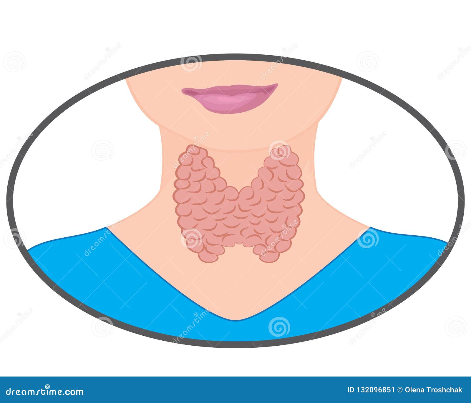 Enlarged Thyroid. Endocrine Disfunction Vector Illustration on a White ...