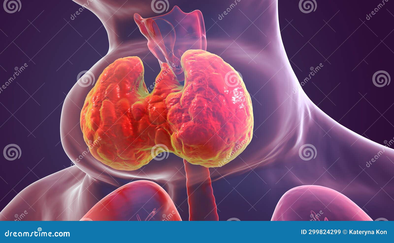 Enlarged Thyroid Gland, 3D Illustration Stock Illustration ...