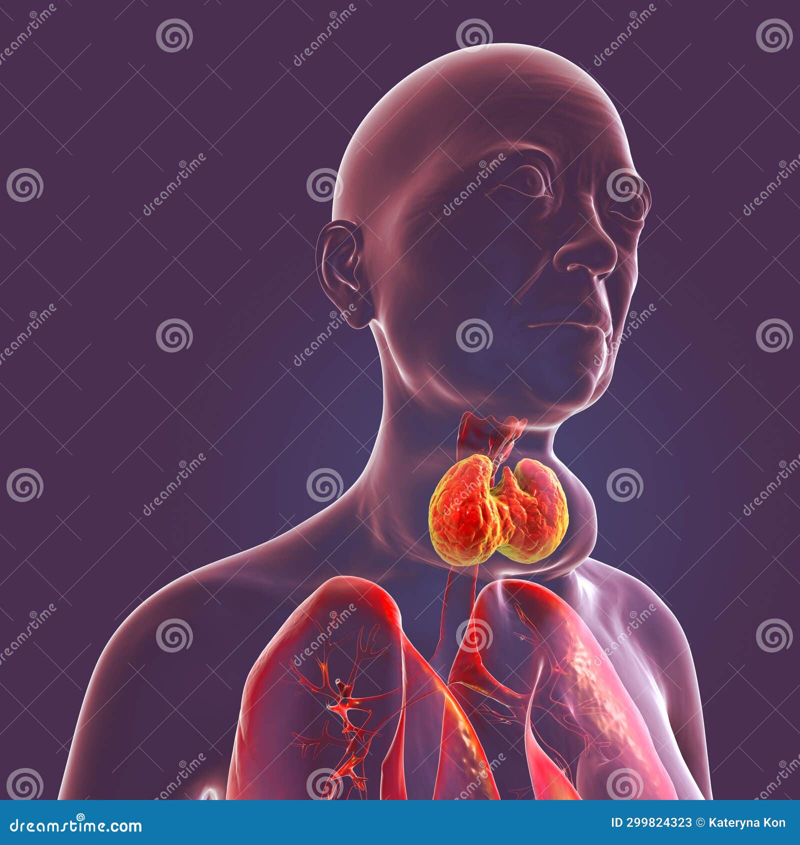 A Man With Enlarged Thyroid Gland, 3D Illustration, And Micrograph ...