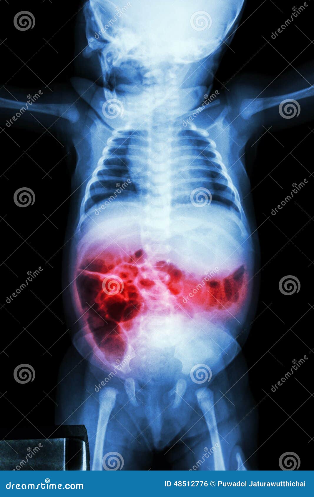Enteritis (X-ray of Sick Infant and Inflammation of Intestine) Stock ...