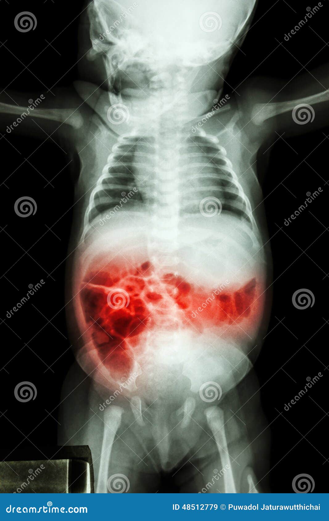 Enteritis (X-ray of Sick Infant and Inflammation of Intestine) Stock ...