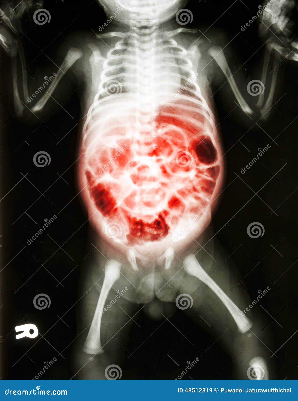Enteritis (X-ray of Sick Infant and Inflammation of Intestine) Stock ...