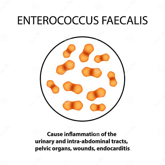 Enterococcus Faecalis. Pathogenic Flora. the Bacterium Causes ...