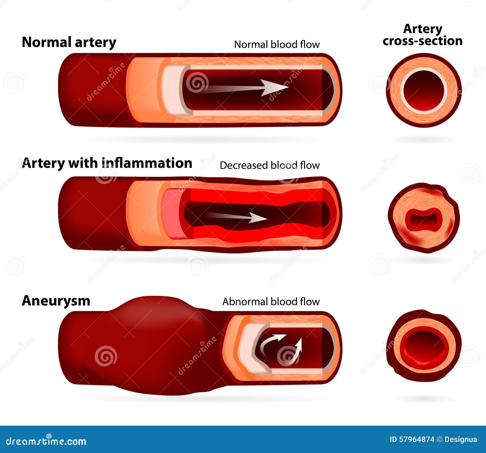 Entflammter Oder Verengter Arterie Der Normalen Arterie, Und Arterie ... Entflammter Oder Verengter Arterie Der Normalen Arterie, Und Arterie ...