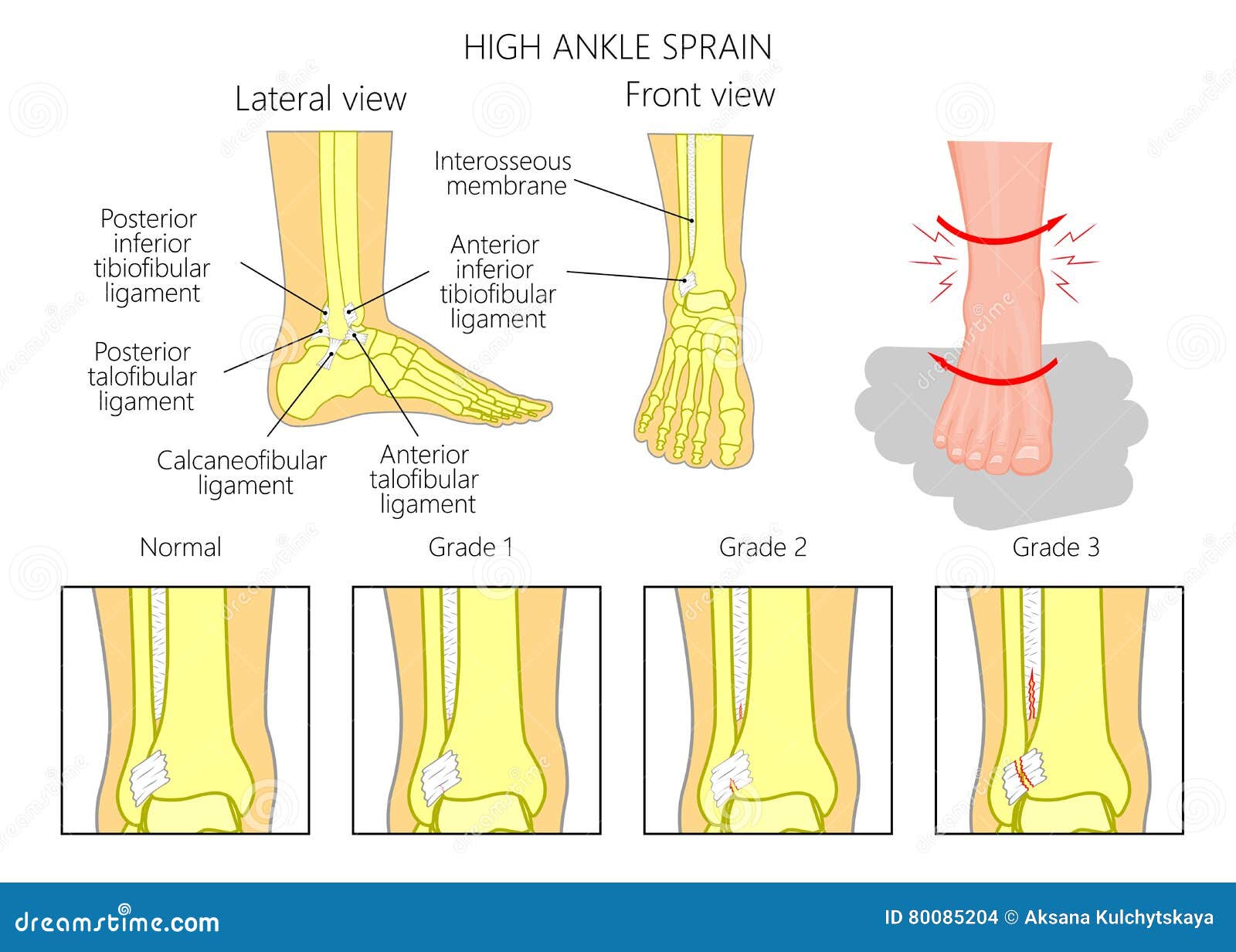 Entorse élevée de cheville illustration de vecteur. Illustration du ...