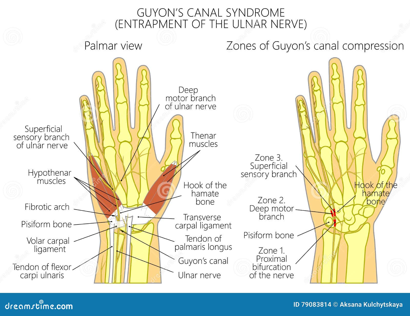 Entrapment Of The Ulnar Nerve In The Wrist In The Guyons Cana Stock Vector Image 79083814