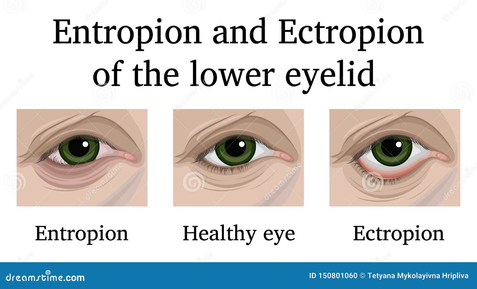 Ectropion Cartoons, Illustrations & Vector Stock Images - 9 Pictures to ...