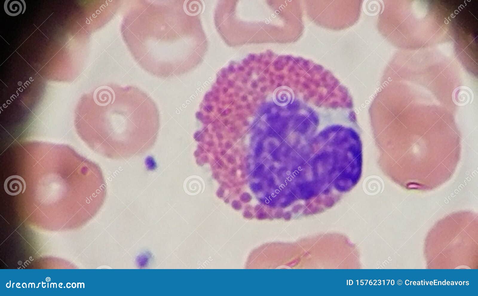 Eosinophil and Red Blood Cells on Peripheral Blood Smear Stock Photo ... Eosinophil and Red Blood Cells on Peripheral Blood Smear Stock Photo ...