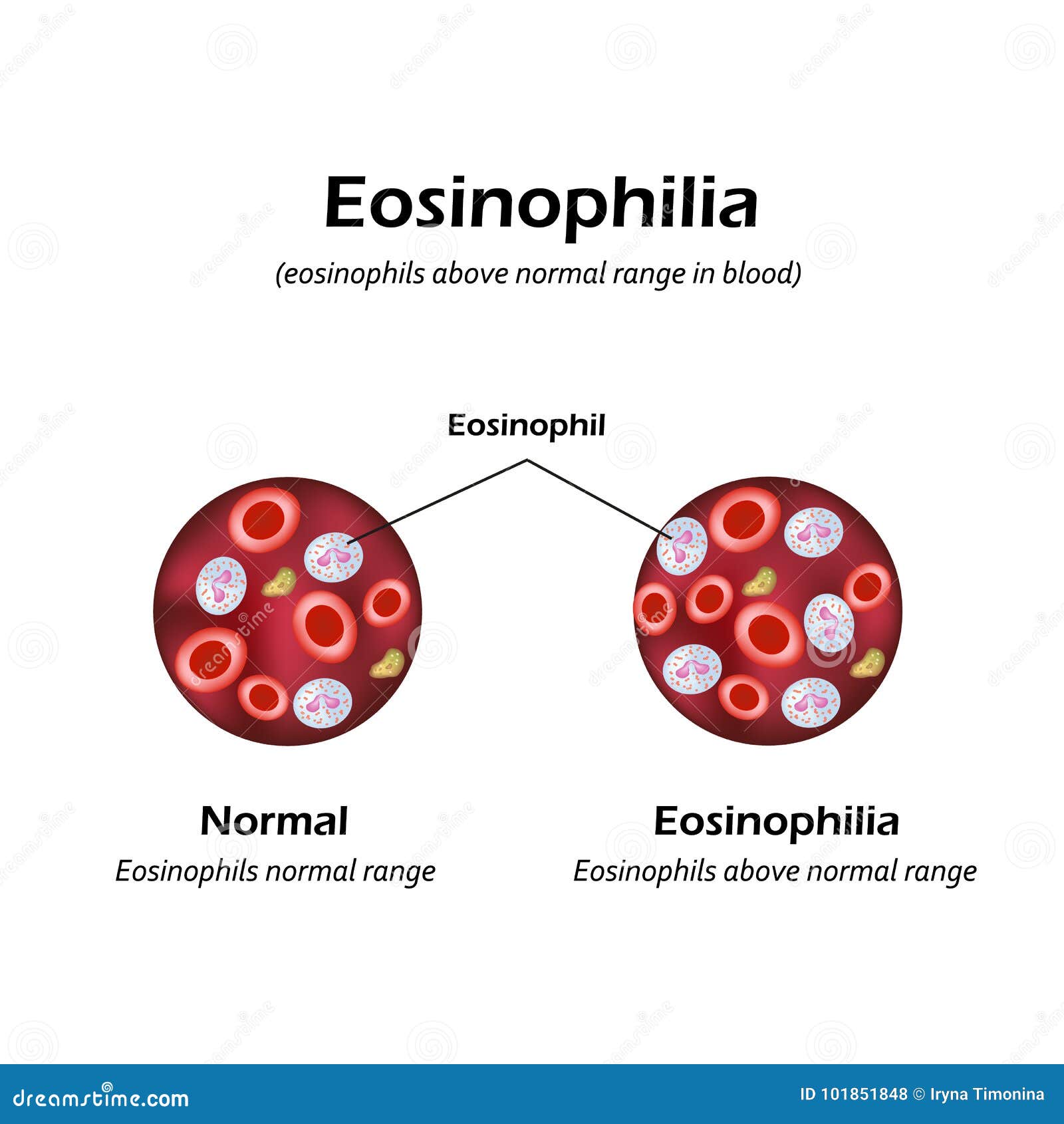 Eosinophils Diagram