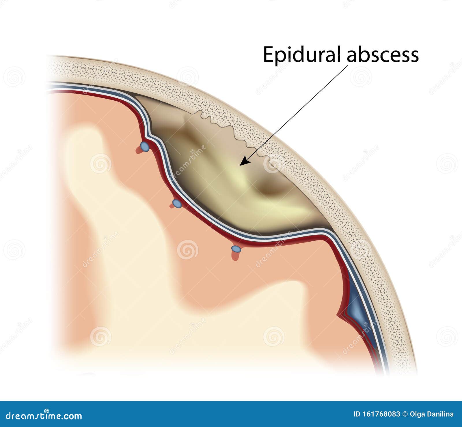 Epidural Abscess Cartoon Vector | CartoonDealer.com #57434755
