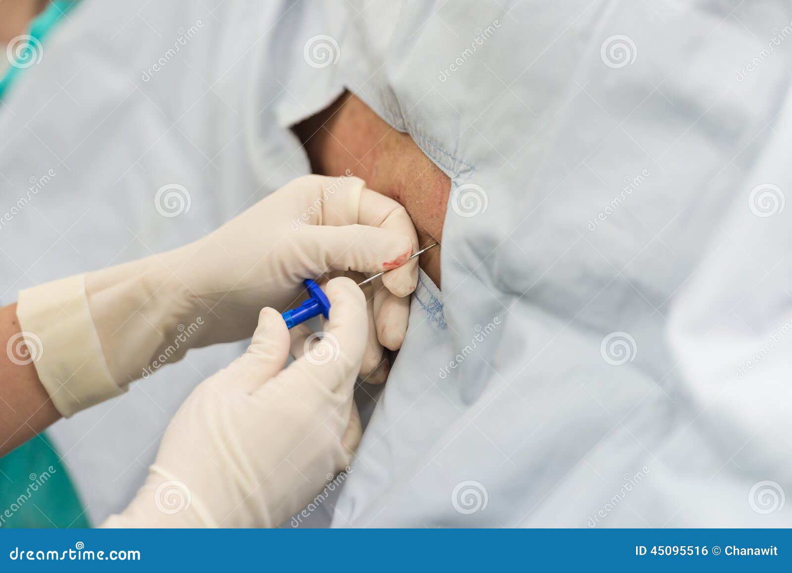 Epidural analgesia stock photo. Image of paraplegia, medical - 45095516