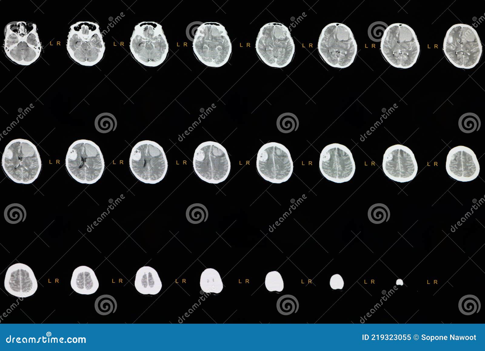 Epidural Hematoma at Right Parietal Loab and Subdural Hematoma at Left ... Epidural Hematoma at Right Parietal Loab and Subdural Hematoma at Left ...