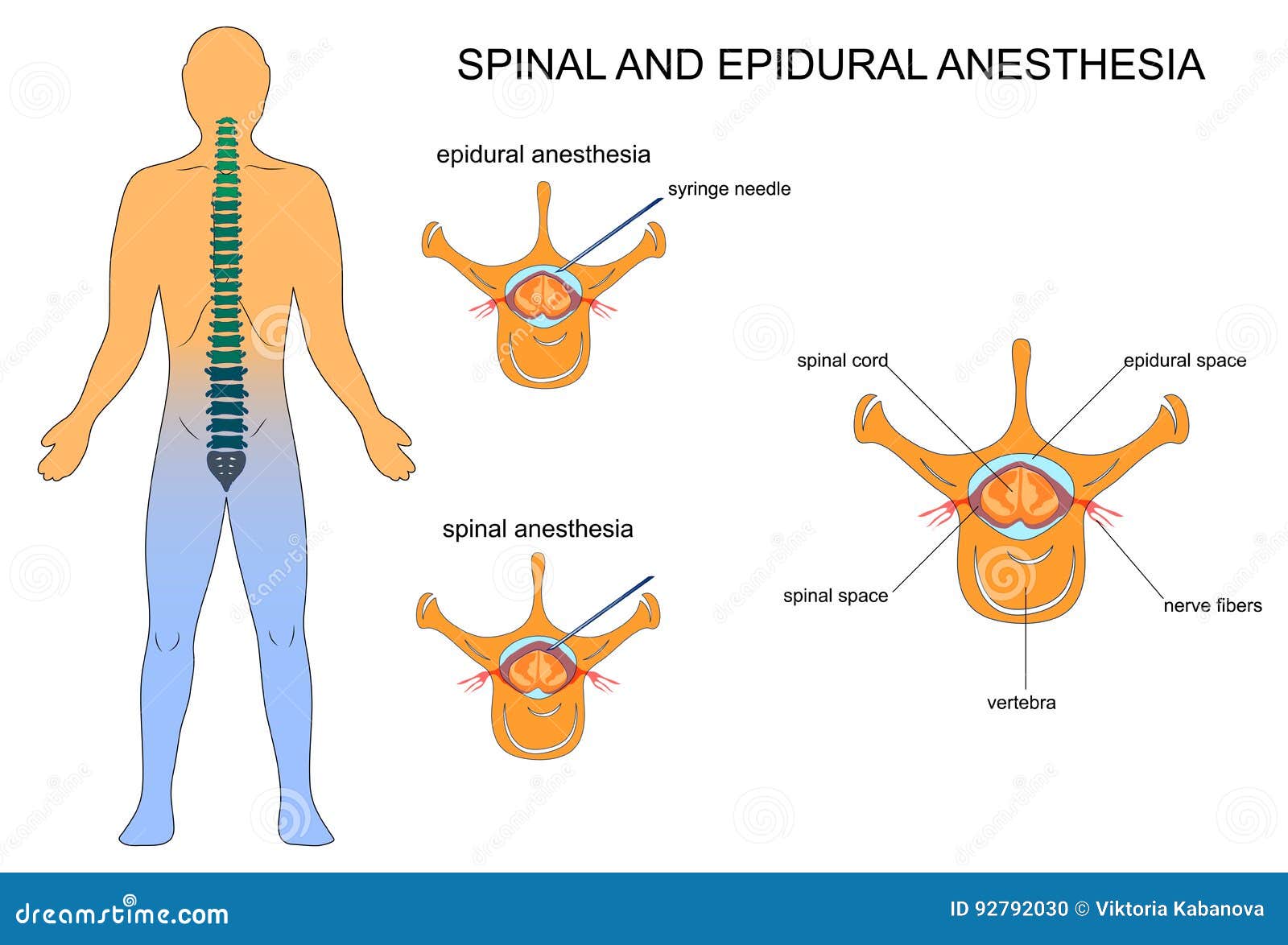 Epidural and Spinal Anaesthesia Stock Vector - Illustration of ...