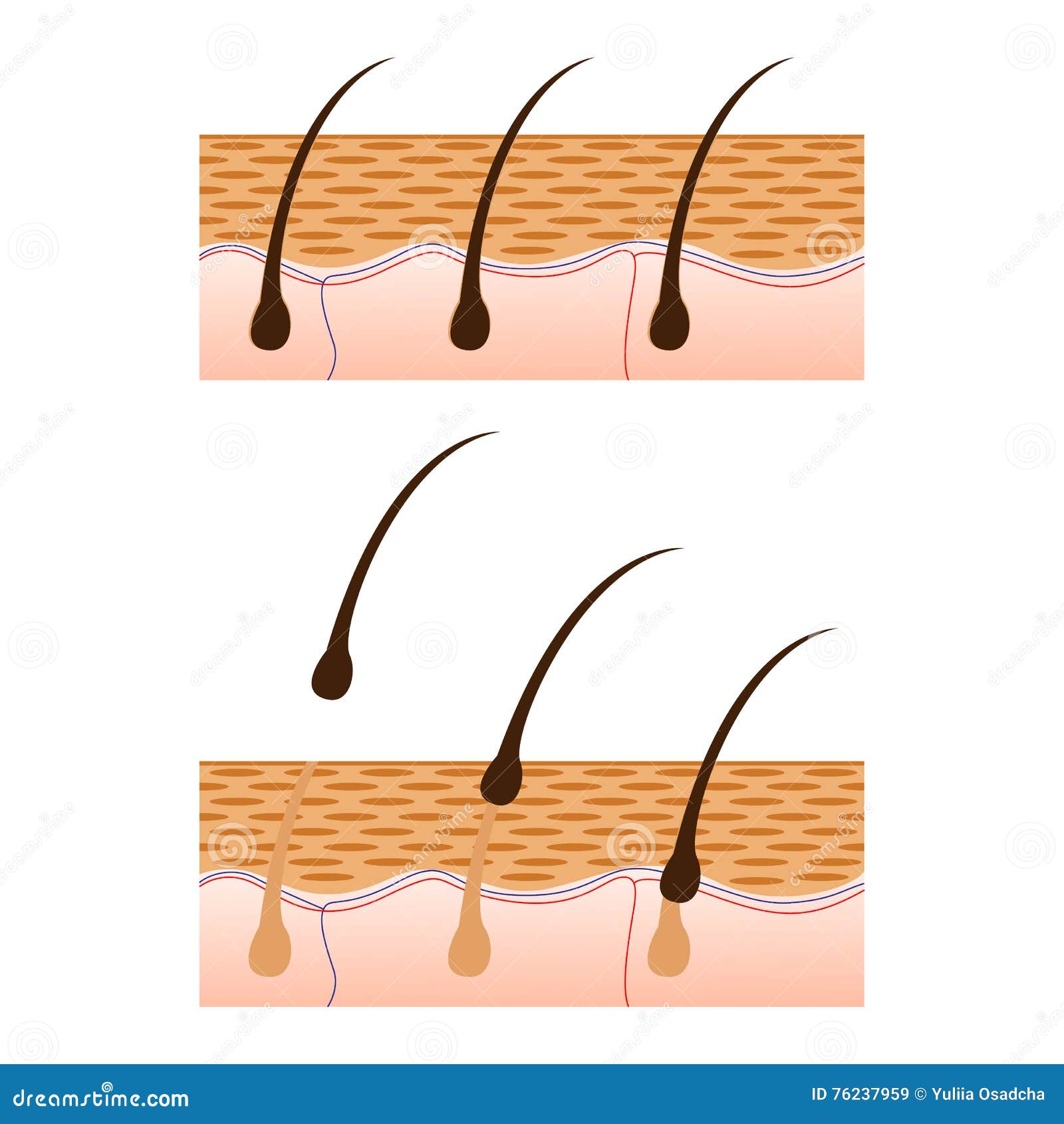 Epilation and Skin with Hair Sectional View. Stock Vector ...