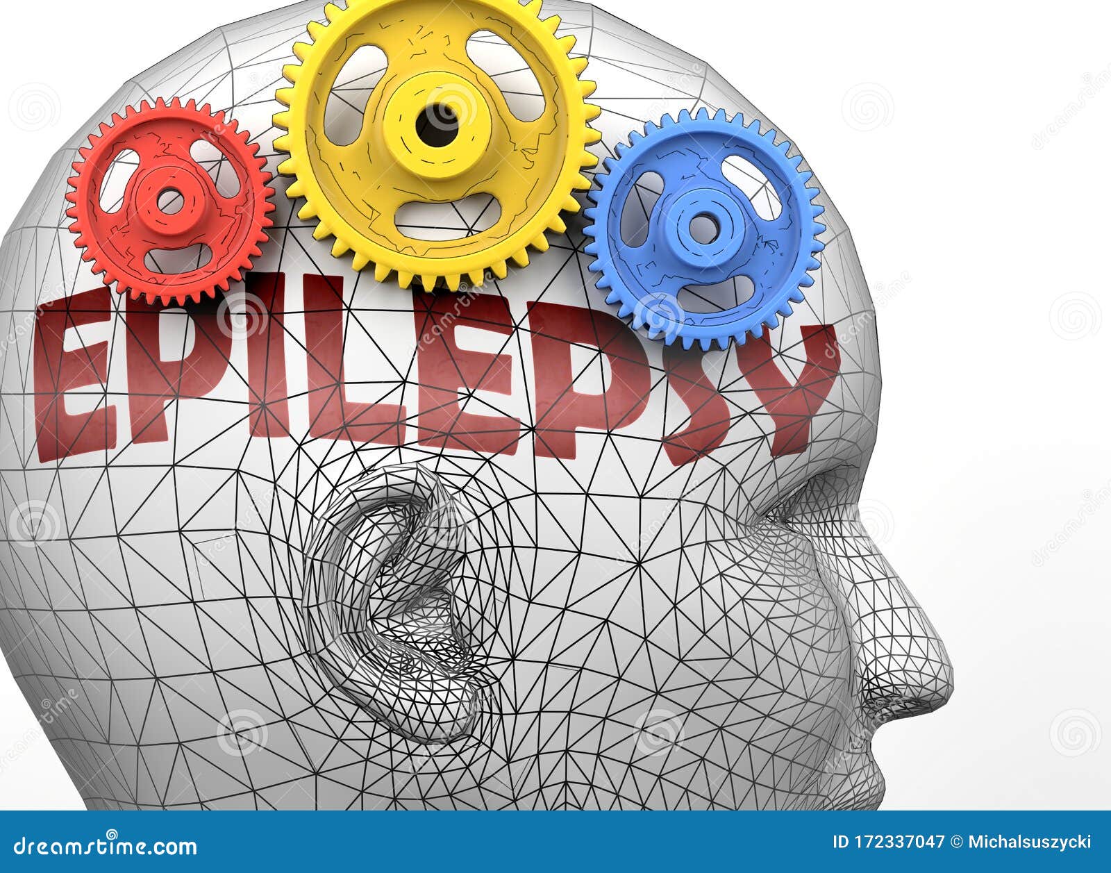Epilepsy and Human Mind - Pictured As Word Epilepsy Inside a Head To ...