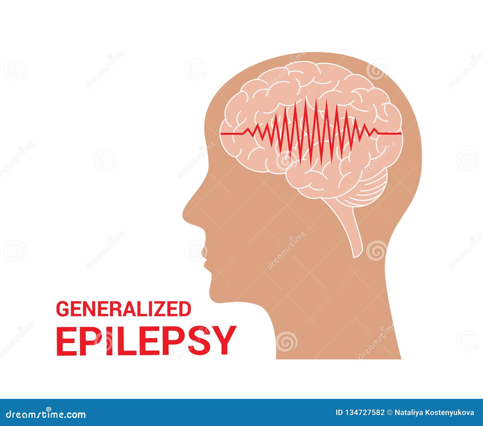 Epilepsy Vector Illustration. Labeled Sick CNS Disorder Educational ...