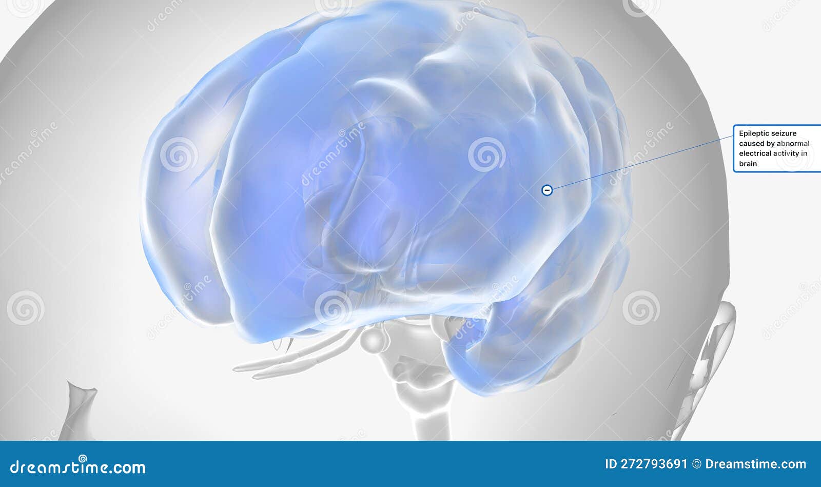 Epileptic Seizure Caused by Abnormal Electrical Activity in Brain Stock ...