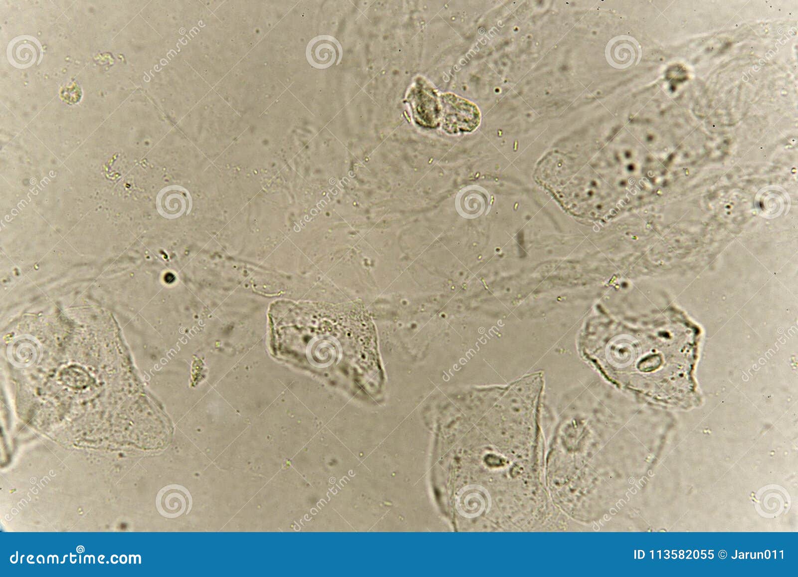 Epithelial Cells with Bacteria in Patient Urine Stock Image - Image of ...