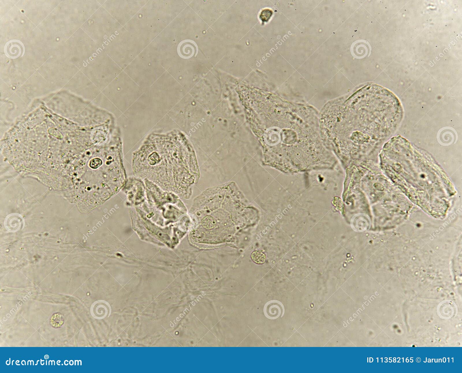 Epithelial Cells With Bacteria In Patient Urine Royalty-Free Stock ...