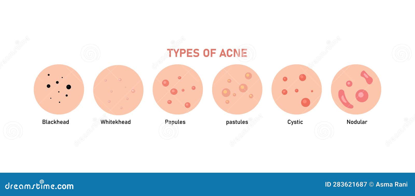 Types of Acne, Pimples Blackheads, Whitehead, Papules, Cystic and ...