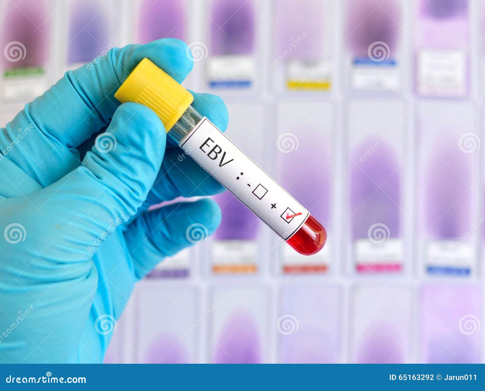 Epstein-Barr Virus (EBV) Positive Stock Photo - Image of scientific ...