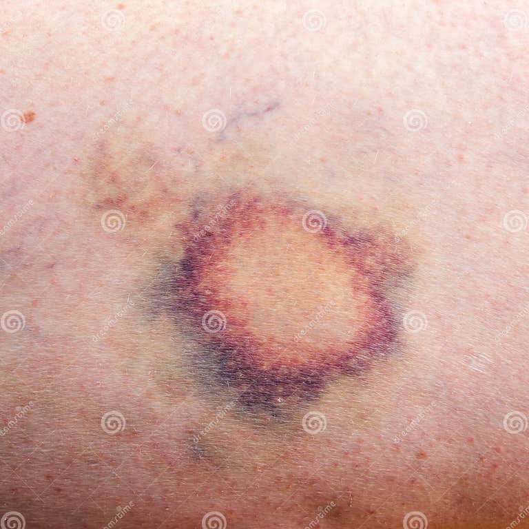 Equimose imagem de stock. Imagem de doloroso, pele, humano - 30516979
