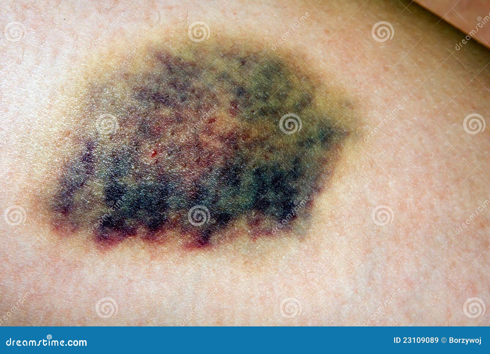 Equimose colorida imagem de stock. Imagem de problema - 23109089
