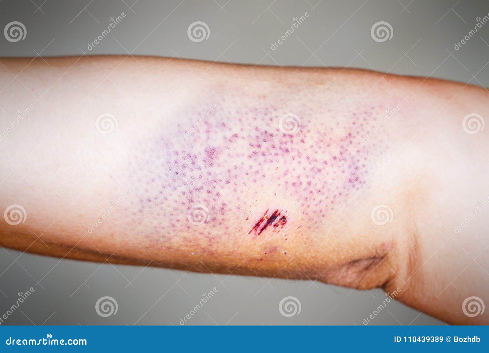 Equimose na pele imagem de stock. Imagem de acidente - 110439389