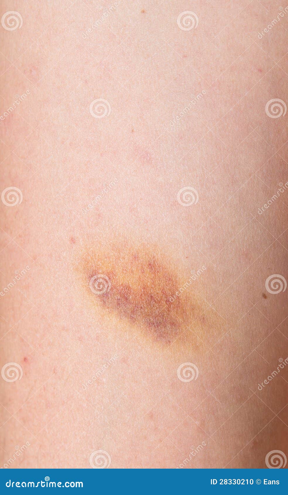 Equimose na pele foto de stock. Imagem de danificado - 28330210