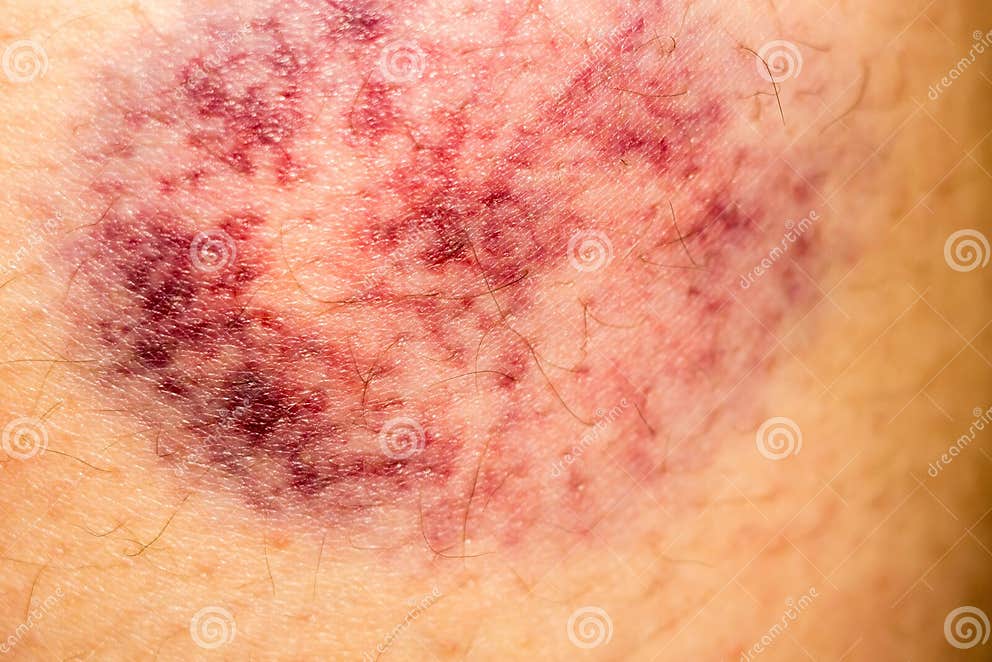 Equimose na pele imagem de stock. Imagem de pele, ferido - 75399051