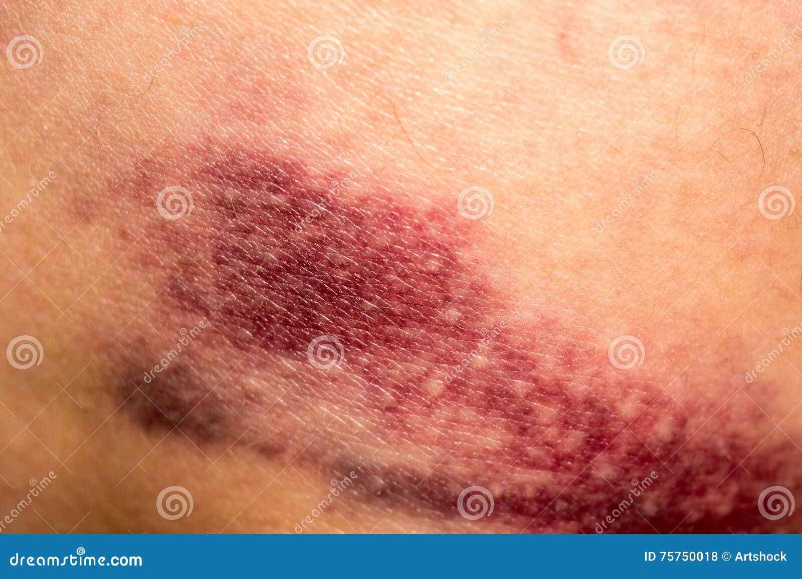 Equimose na pele foto de stock. Imagem de humano, macro - 75750018