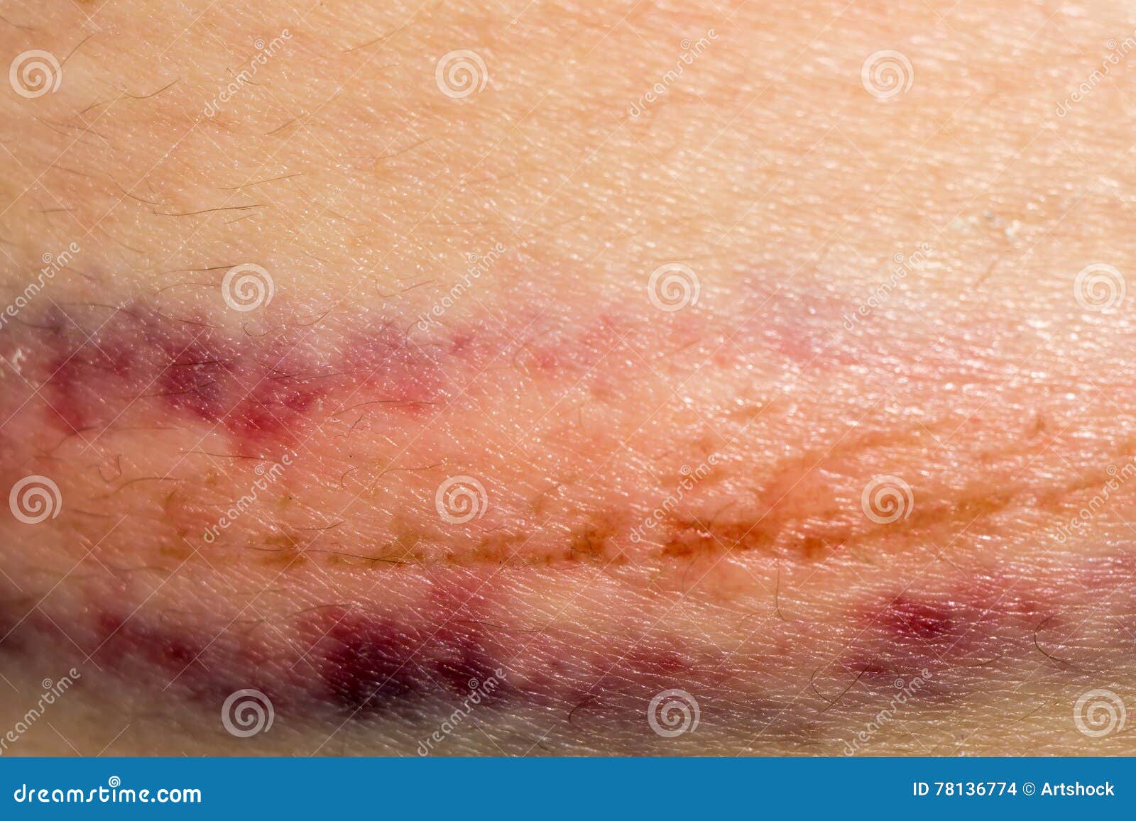 Equimose na pele foto de stock. Imagem de humano, ferimento - 78136774