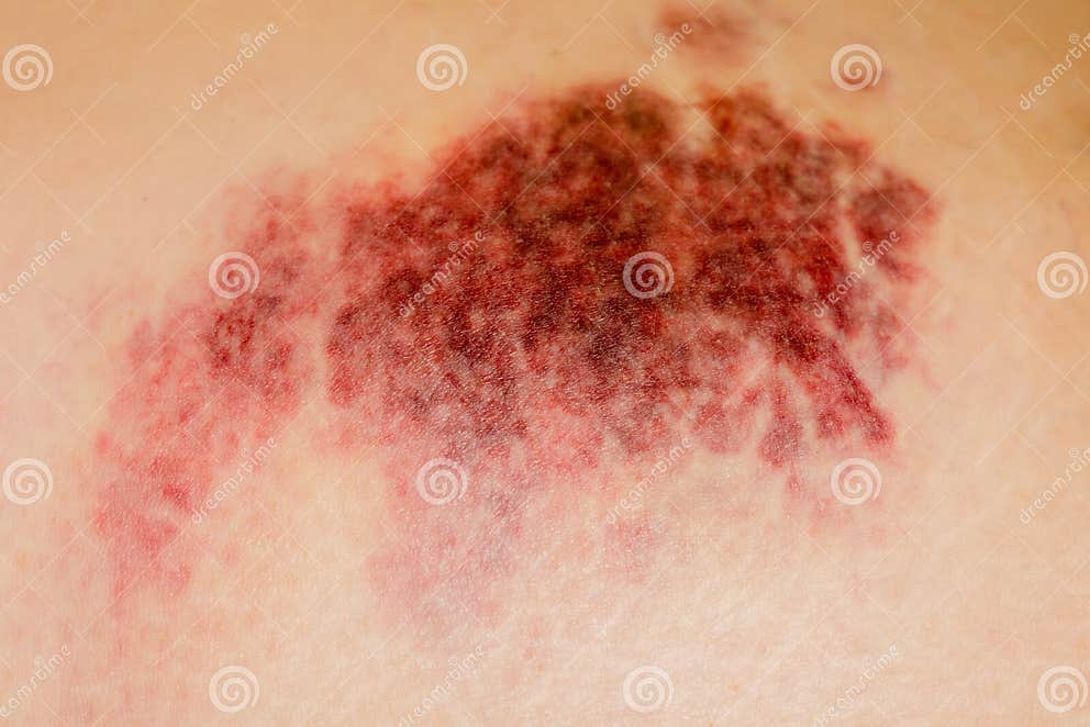 Equimose na pele foto de stock. Imagem de medicina, macro - 99620448