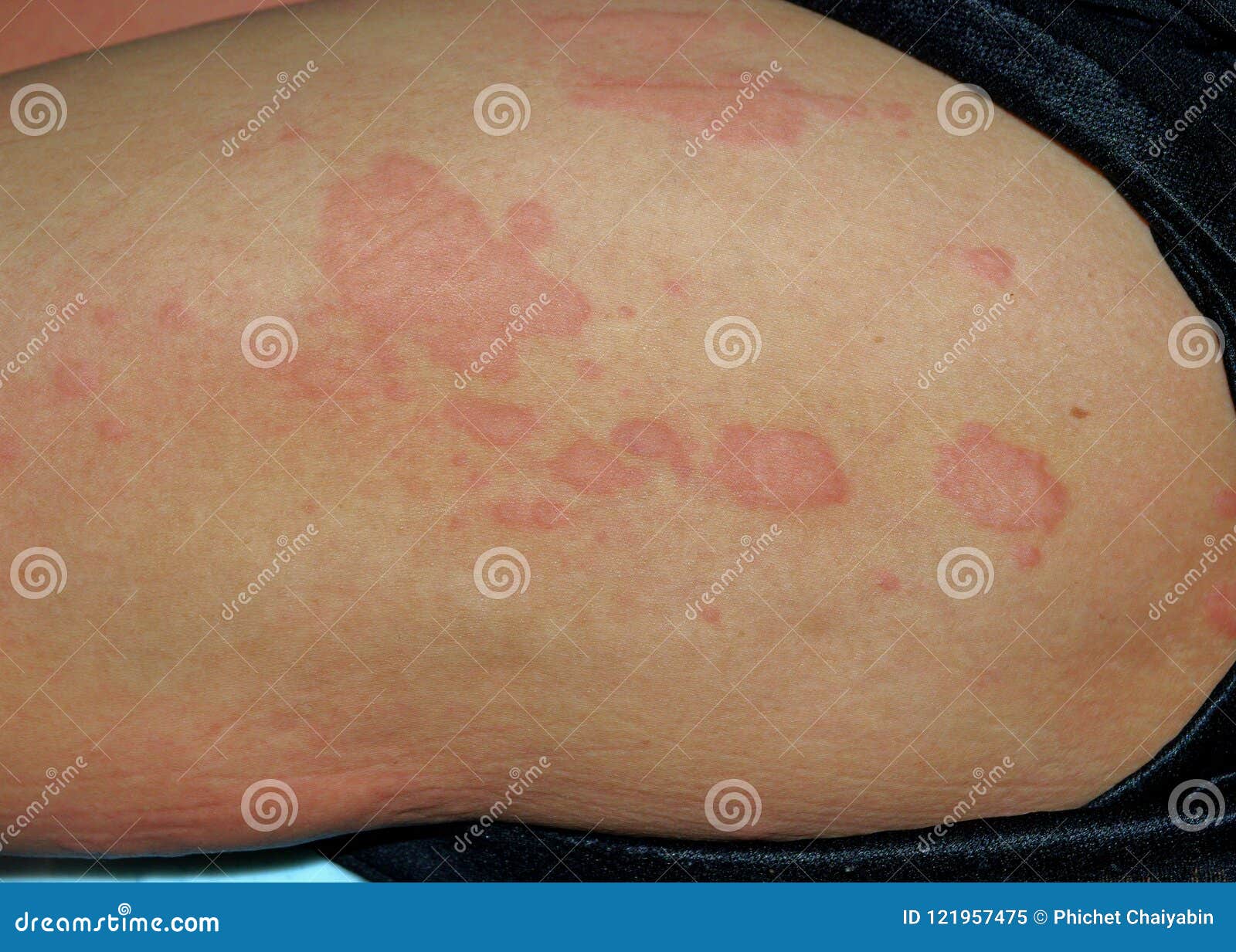 Eruzione di orticaria immagine stock. Immagine di eruzione - 121957475