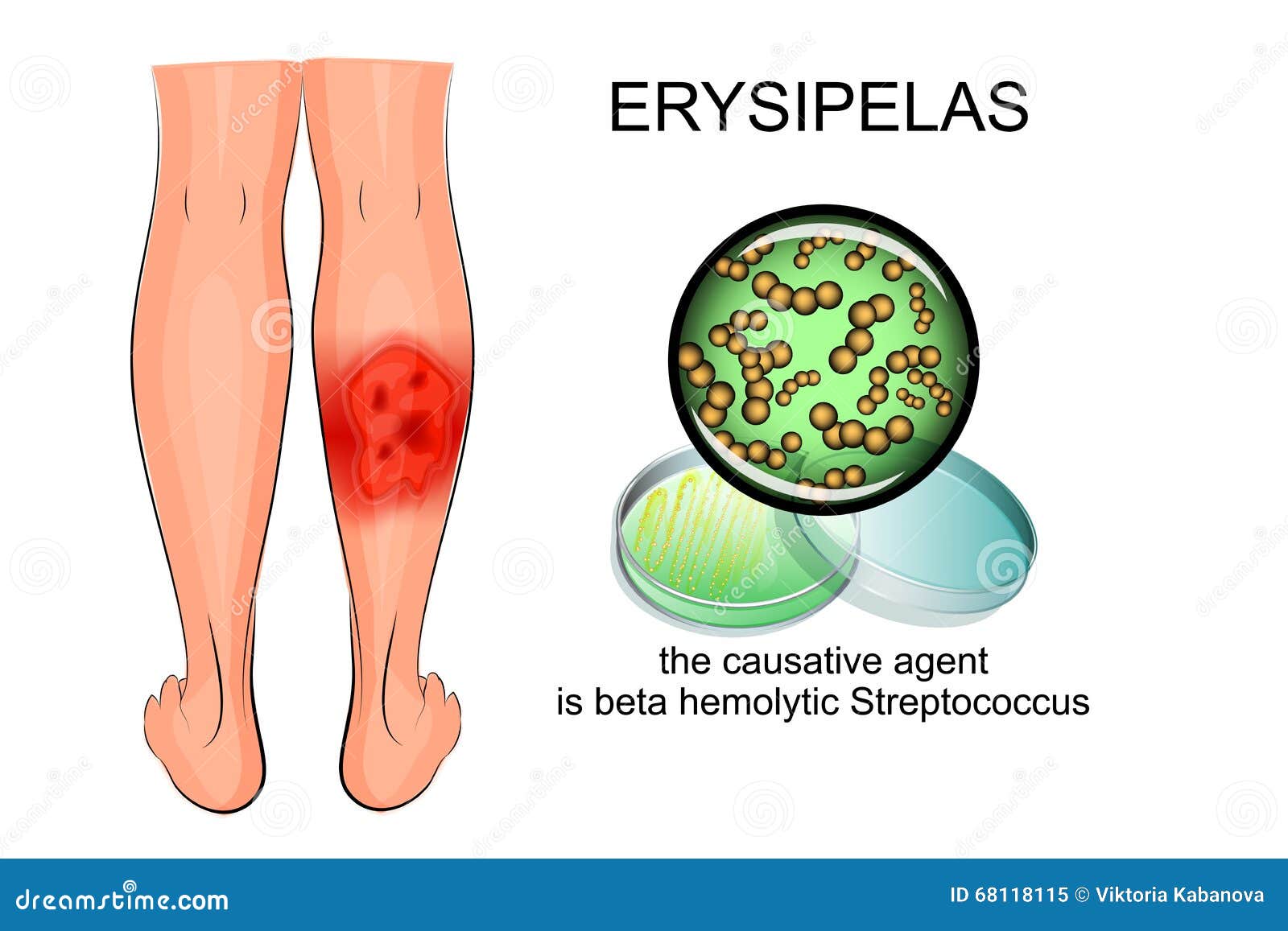 Erysipelas Cartoons, Illustrations & Vector Stock Images - 131 Pictures ...